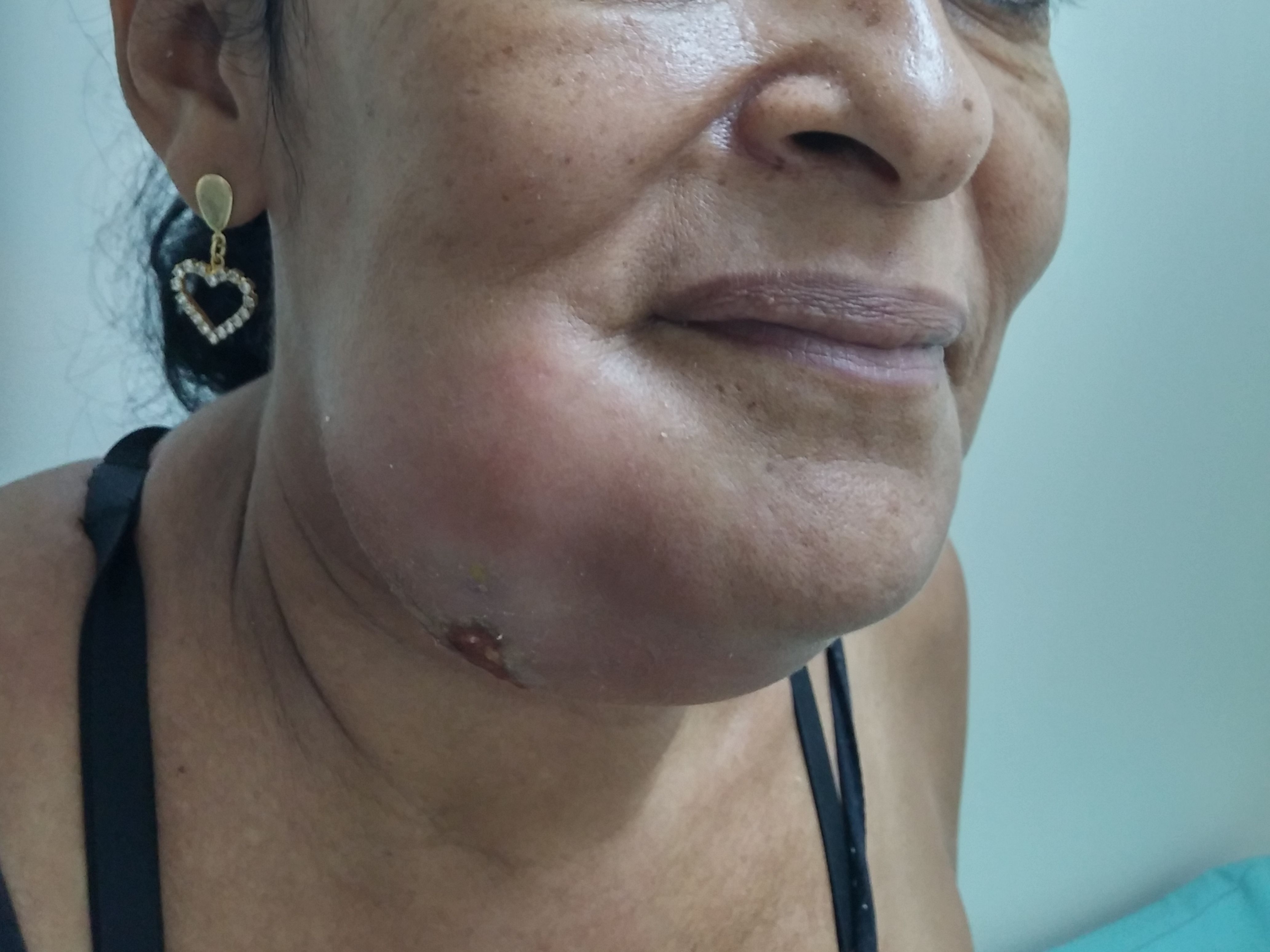 Angina de Ludwig - Dr. Feijão